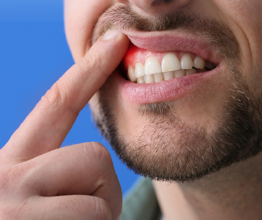 Jakie są pierwsze oznaki paradontozy? Objawy, przyczyny i sposoby ...